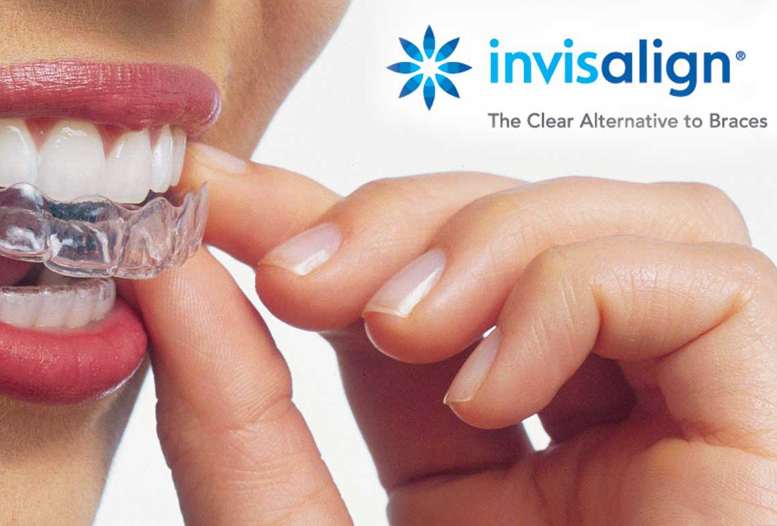 Onzichtbare beugels – Orthodontist Hereplein